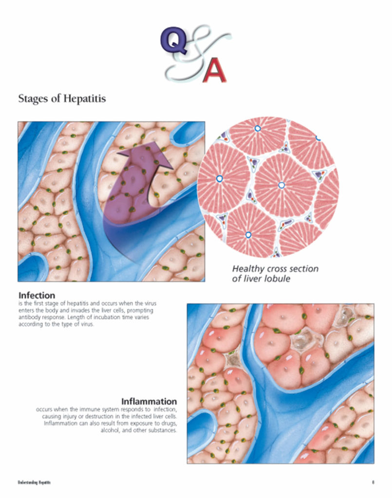 Understanding Hepatitis Flip Chart | Scientific Publishing