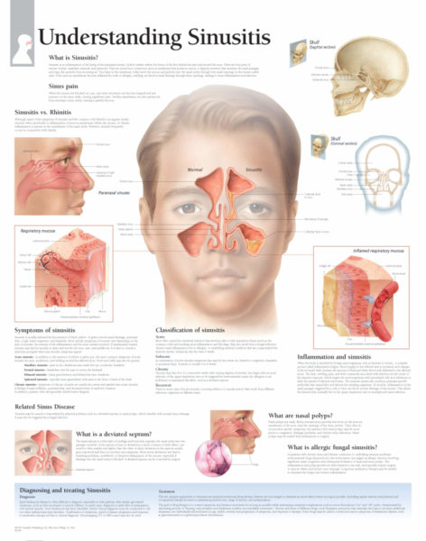 Understanding Sinusitis - Scientific Publishing